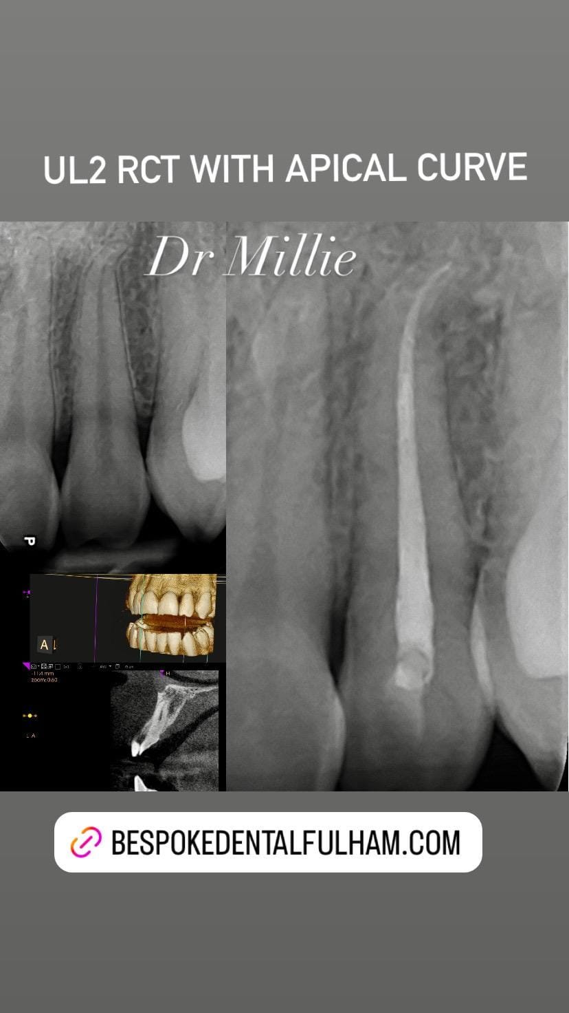 Before & After Root Canal Treatment | Root Canal London